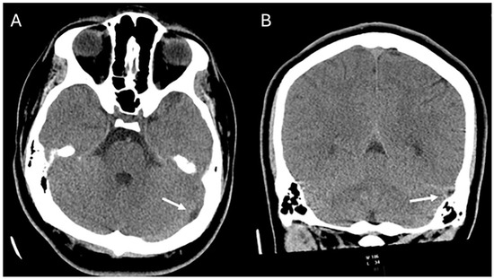 Neuroimaging of Vermiform Giant Arachnoid Granulations in Children