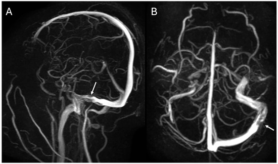 Neuroimaging of Vermiform Giant Arachnoid Granulations in Children