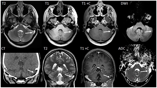 Neuroimaging of Vermiform Giant Arachnoid Granulations in Children