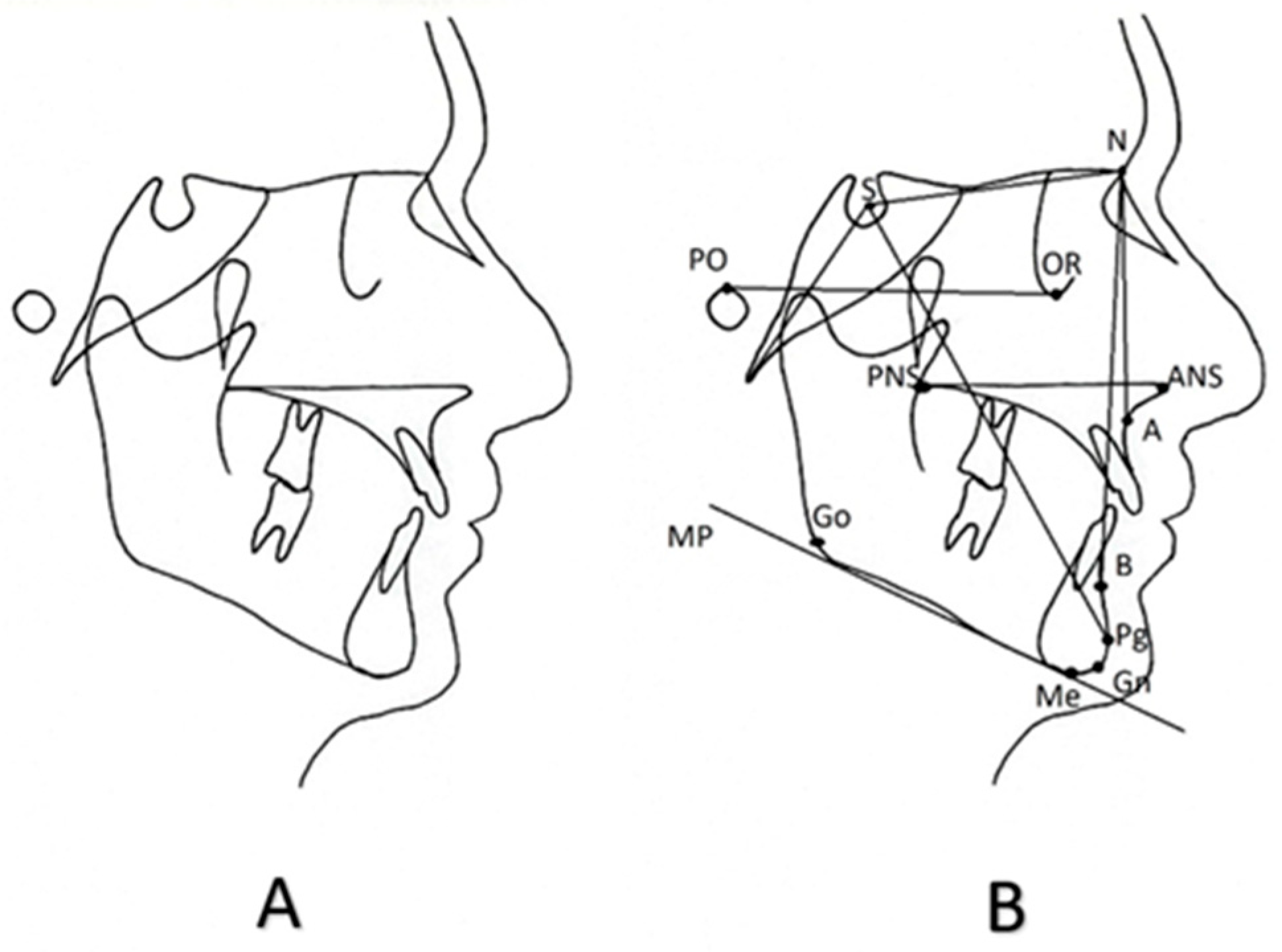 Cephalometric Evaluation of Children with Short Stature of Genetic ...