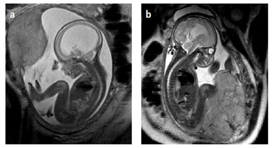 Isolated Fetal Ventriculomegaly: Diagnosis and Treatment in the ...