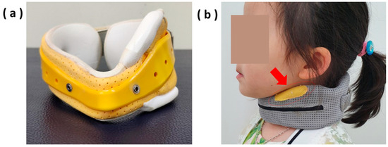 Clinical Application of Custom Neck Collar with Negative Sensory ...