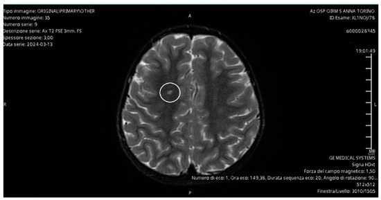Pediatric Post-Pump Chorea: Case Report and Implications for ...