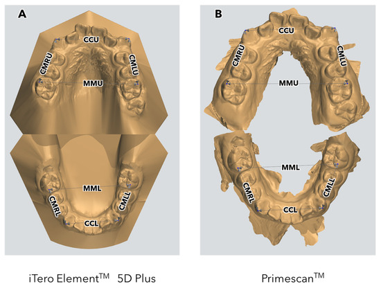 Accuracy Analysis of Digital Models from Intraoral Scanners and 3D ...