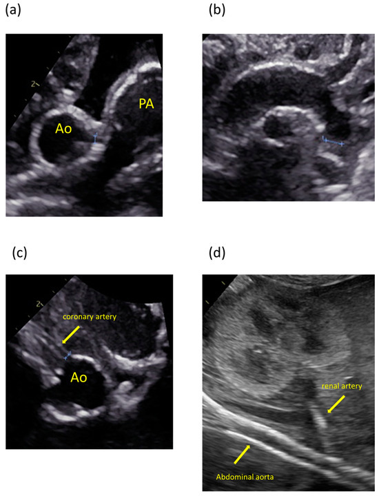 Preterm Infant with Generalized Arterial Calcification of Infancy Who ...