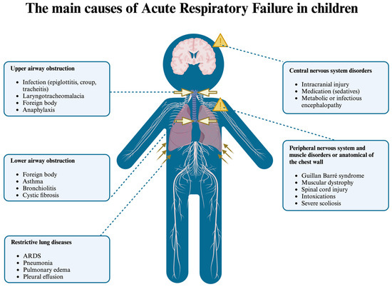 Respiratory Failure