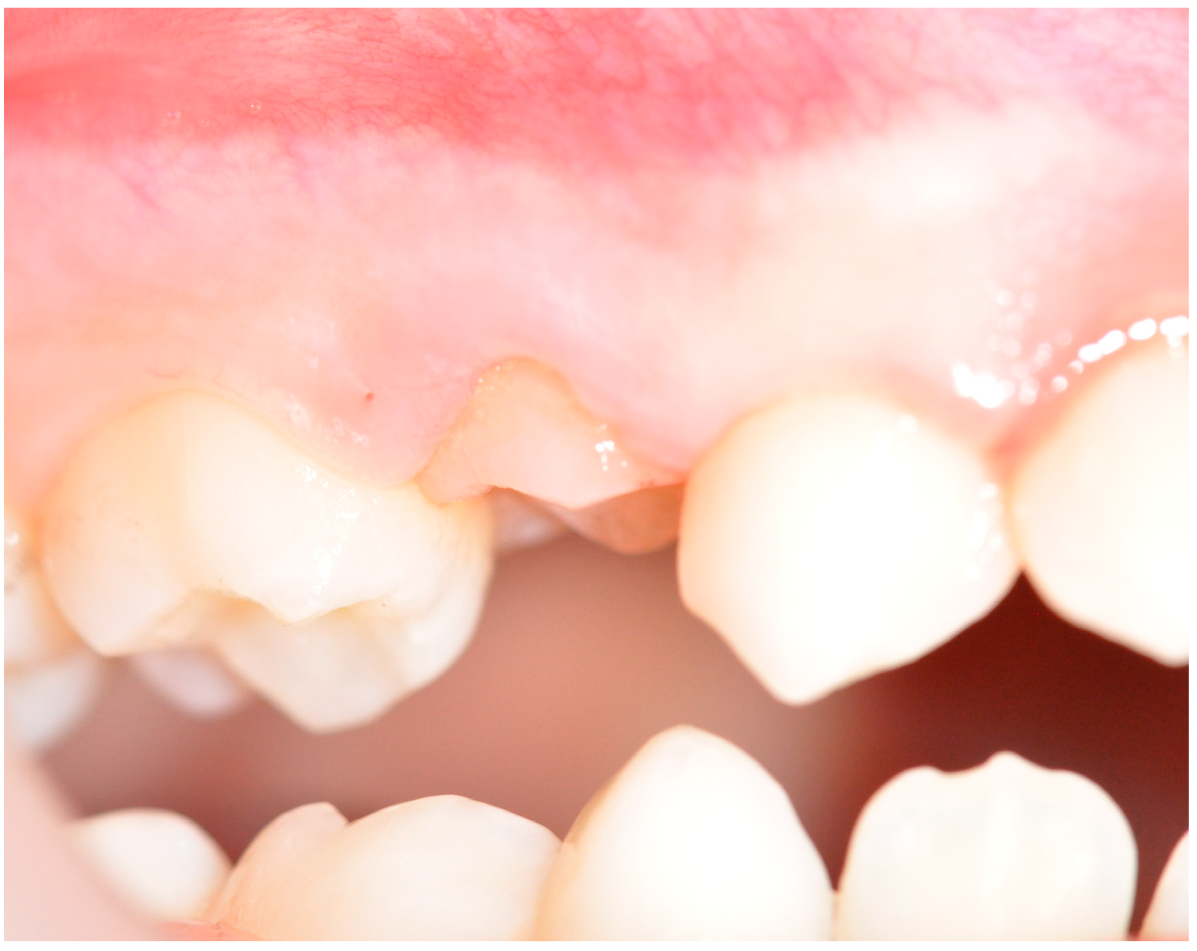 The Diagnosis and Management of Infraoccluded Deciduous Molars: A ...