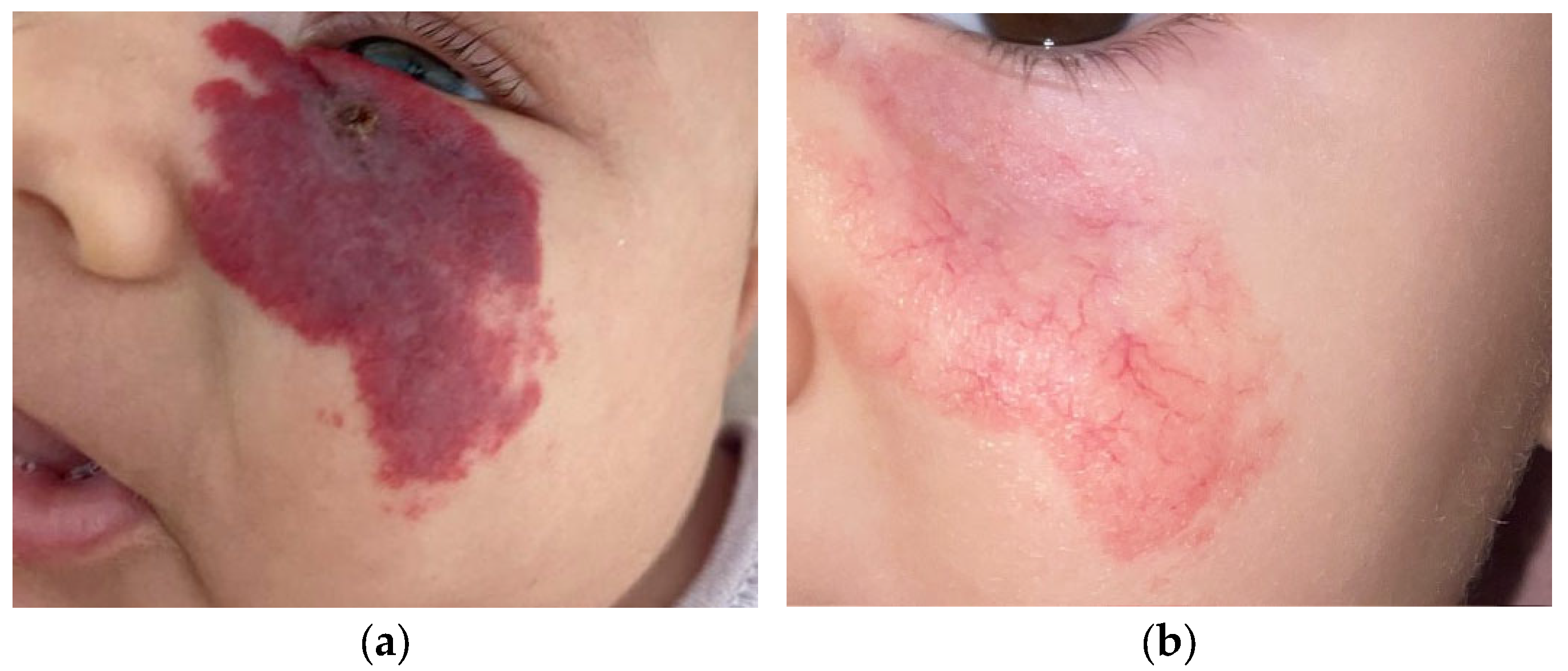 Diagnosis and Treatment of Infantile Hemangioma from the Primary Care ...