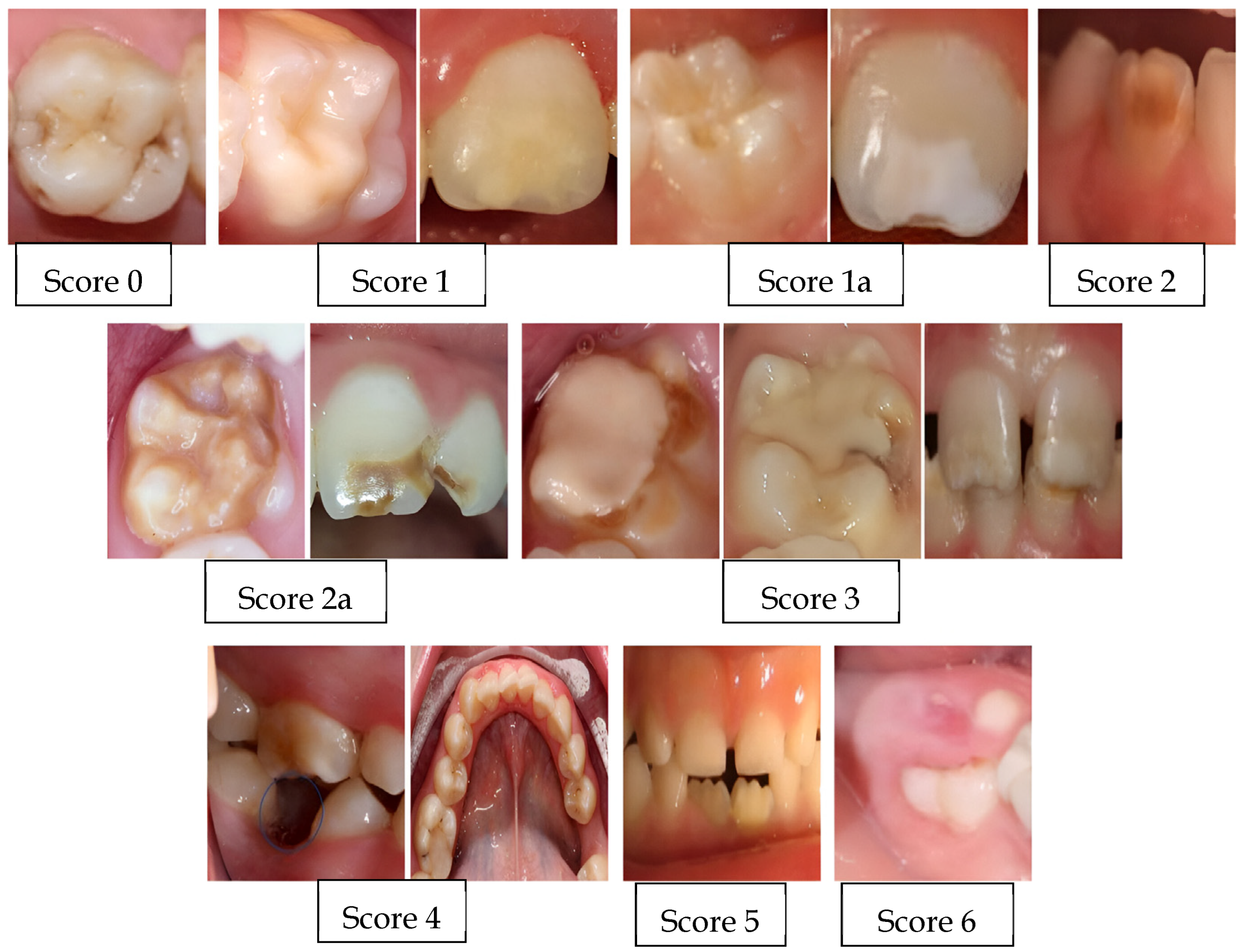 Investigation of the Etiology of Molar Incisor Hypomineralization in ...