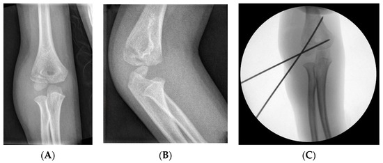 Management of Acute Lateral Humeral Condyle Fractures in Children