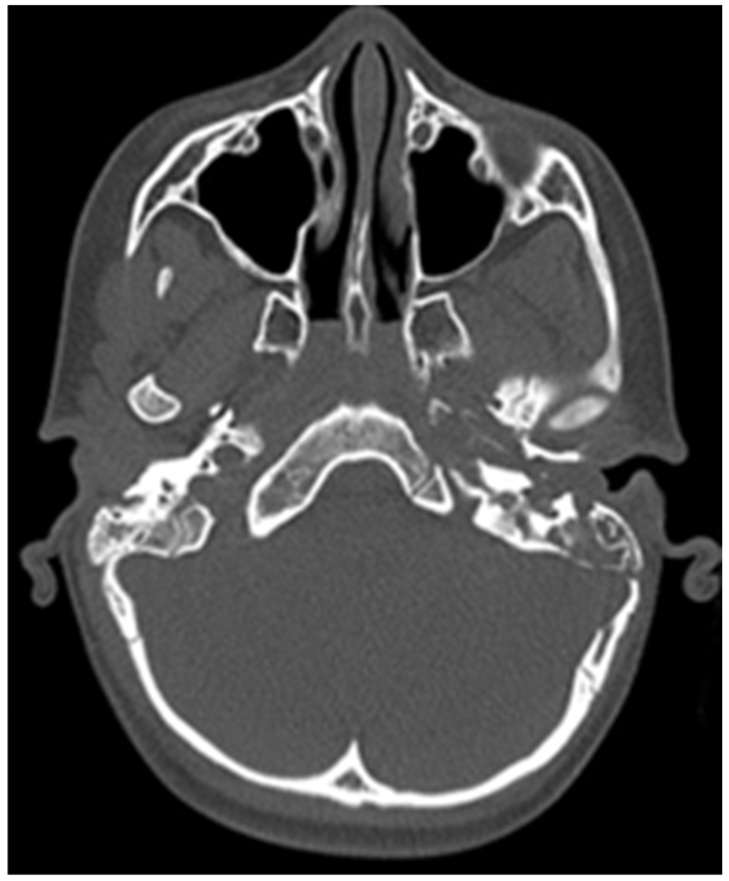 Rhabdomyosarcoma of the Middle Ear Case Report