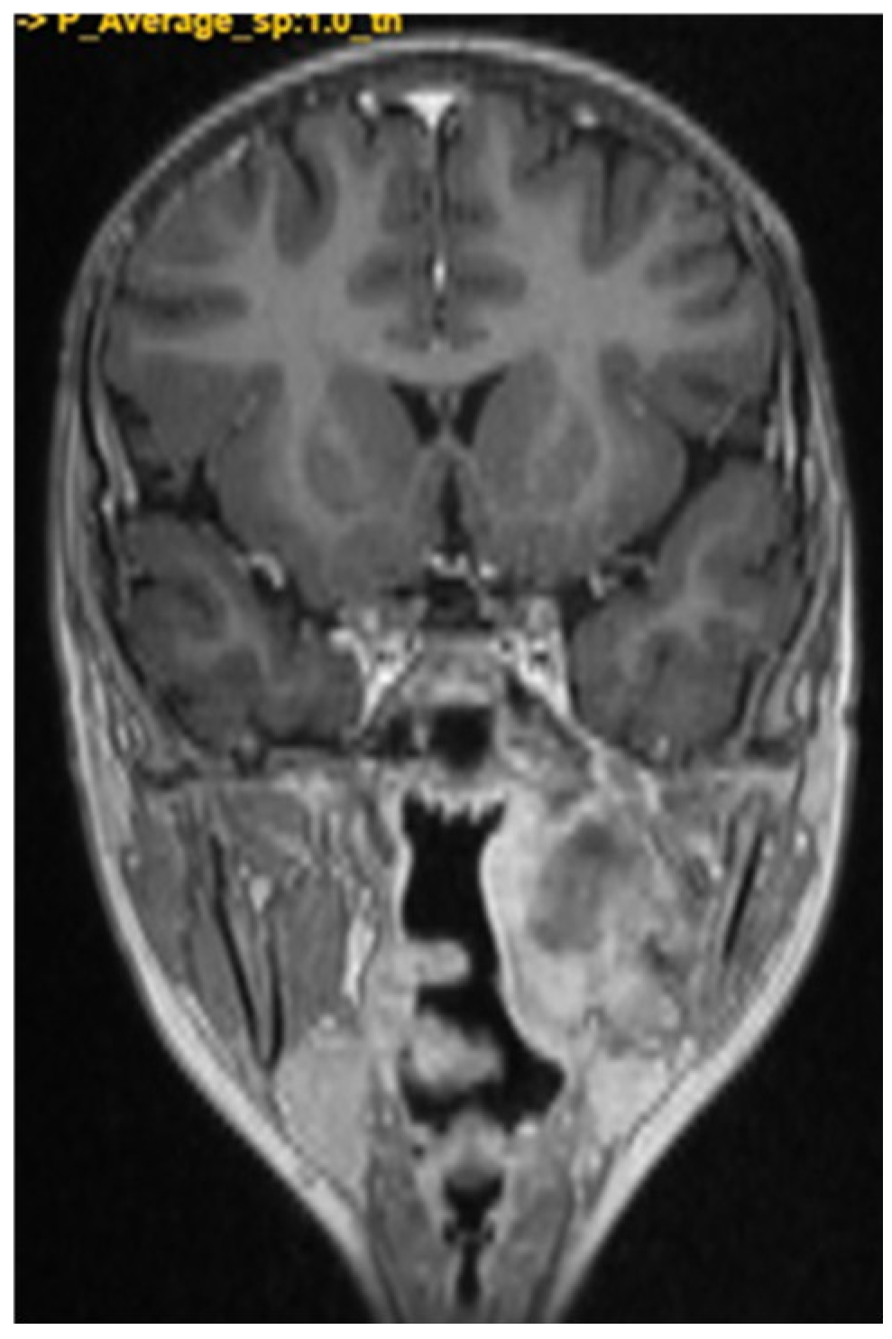 Rhabdomyosarcoma of the Middle Ear Case Report