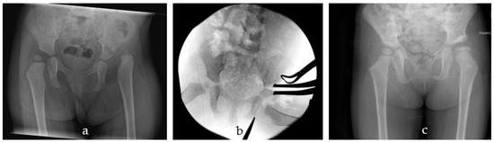 Long-Term Results After Salter Innominate Osteotomy for the Treatment ...