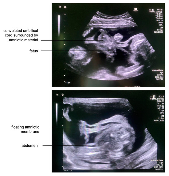 Minimally Invasive Fetoscopic Resection of Life-Threatening Amniotic ...