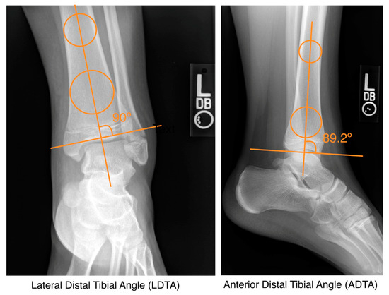 Outcomes After Salter–Harris II Distal Tibia Fractures in Children