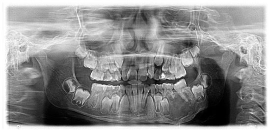 Autotransplantation of Impacted Third Molars to DCIA Free Flap in ...