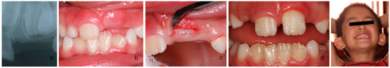 Triple Tooth in Primary Dentition: A Rare Case Report