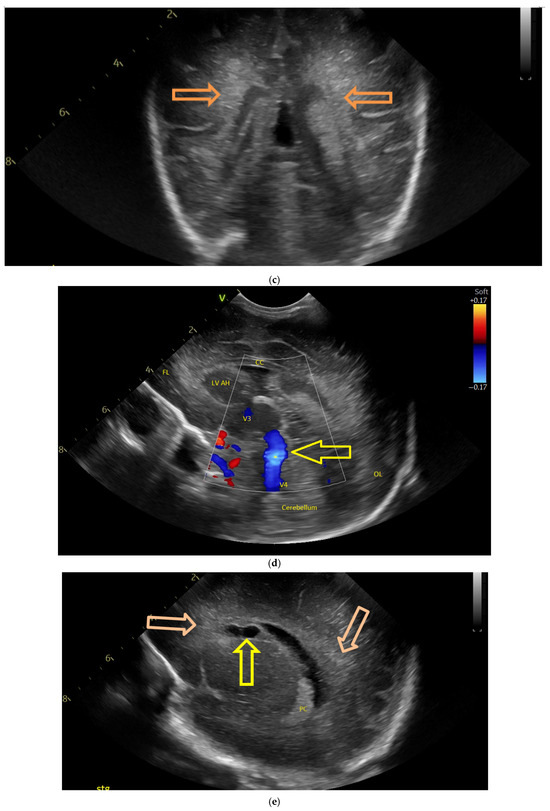 Cranial Ultrasound in the Management of Hydrocephalus in Newborns: A ...