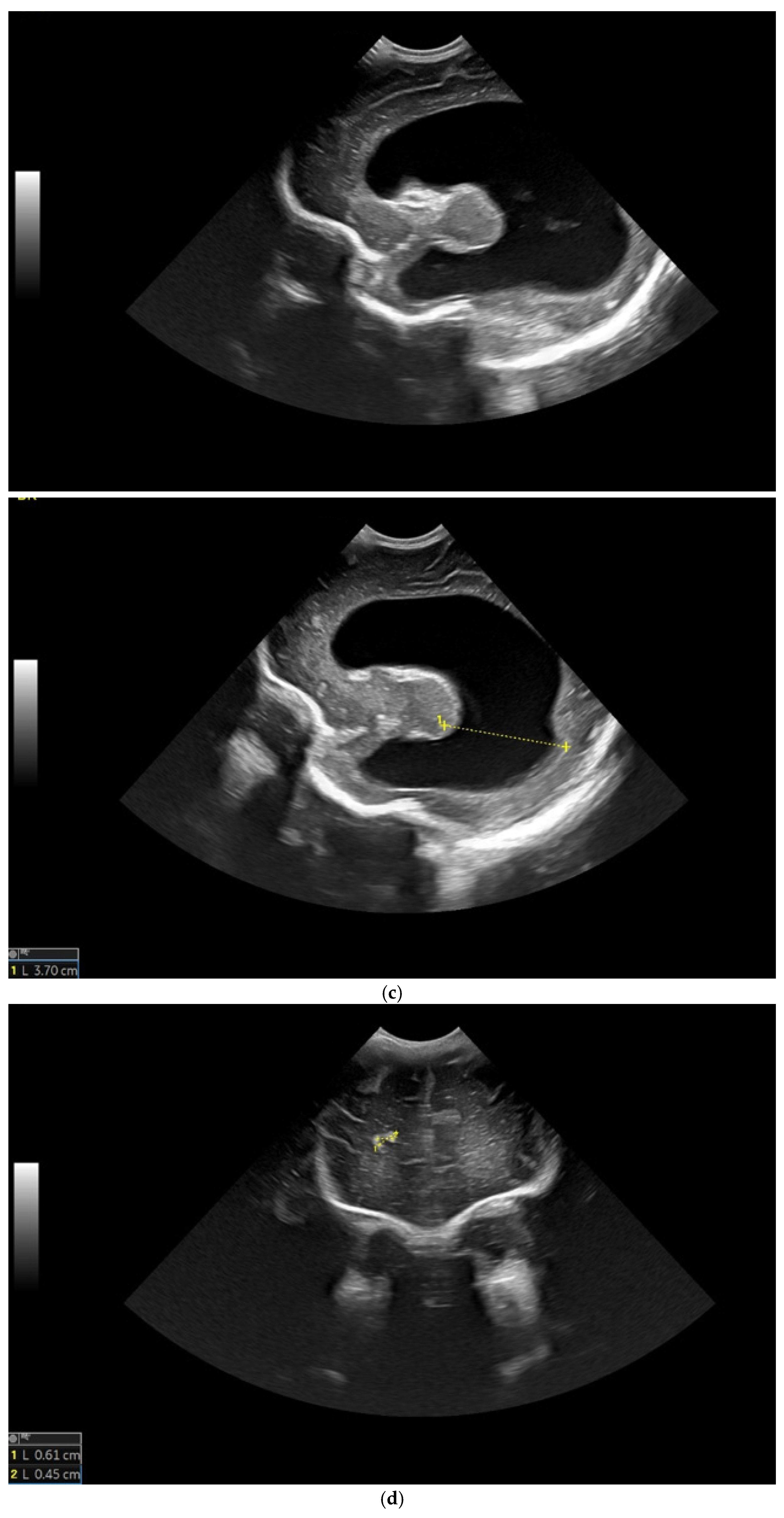 Cranial Ultrasound in the Management of Hydrocephalus in Newborns: A ...