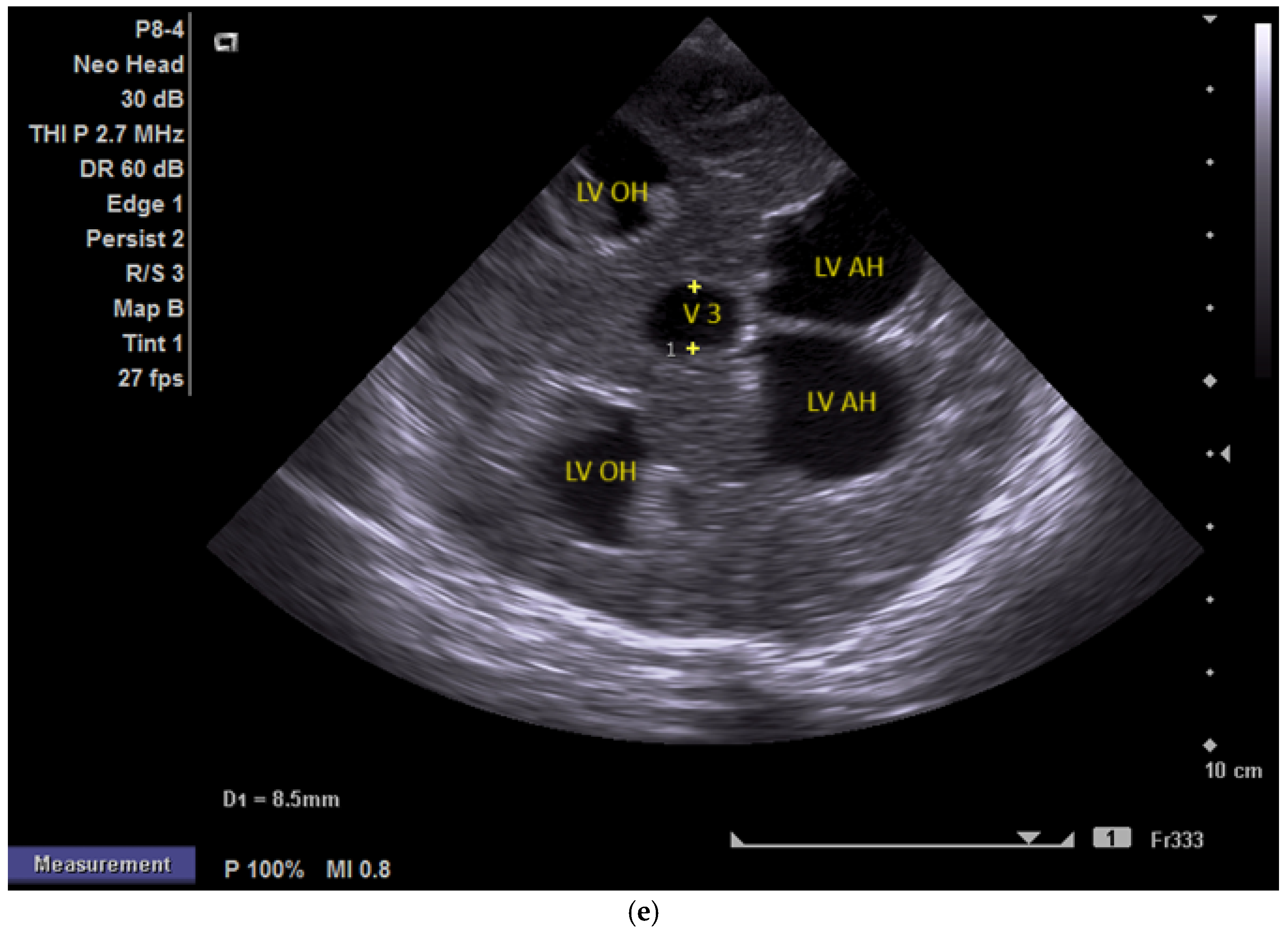 Cranial Ultrasound in the Management of Hydrocephalus in Newborns: A ...