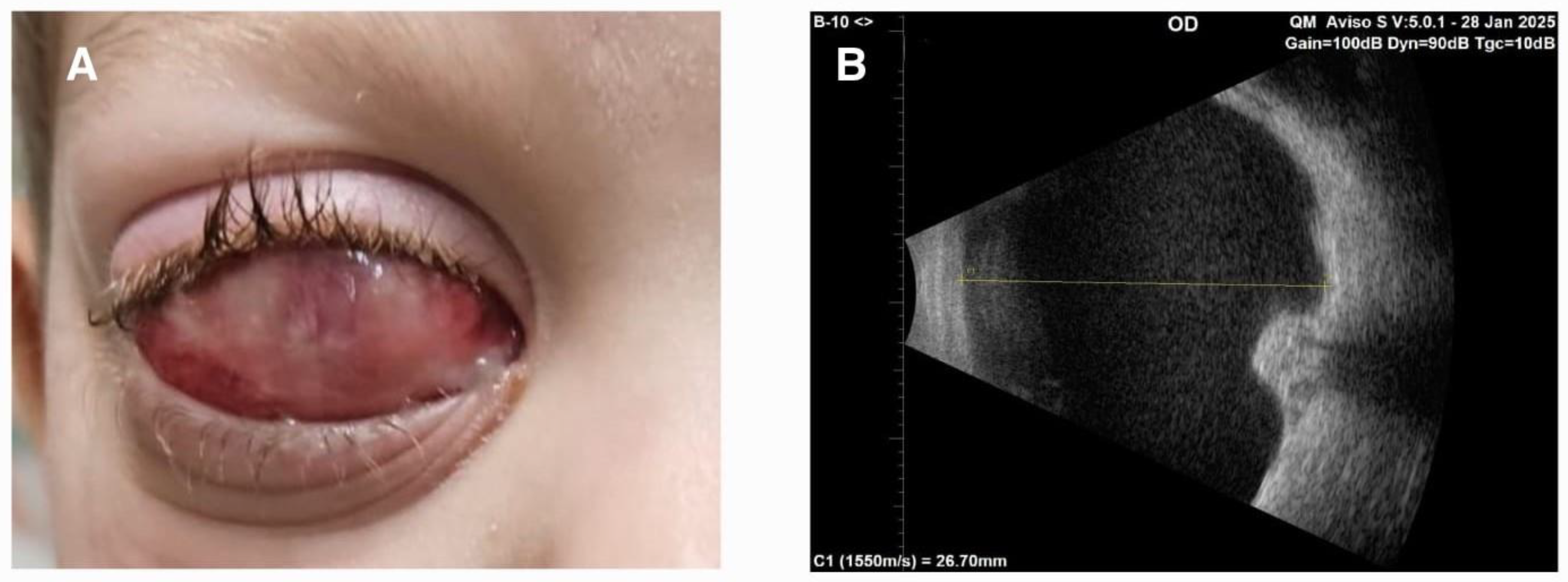 Giant Cyst of Dermis-Fat Graft in a Child with MRSA—Case Report