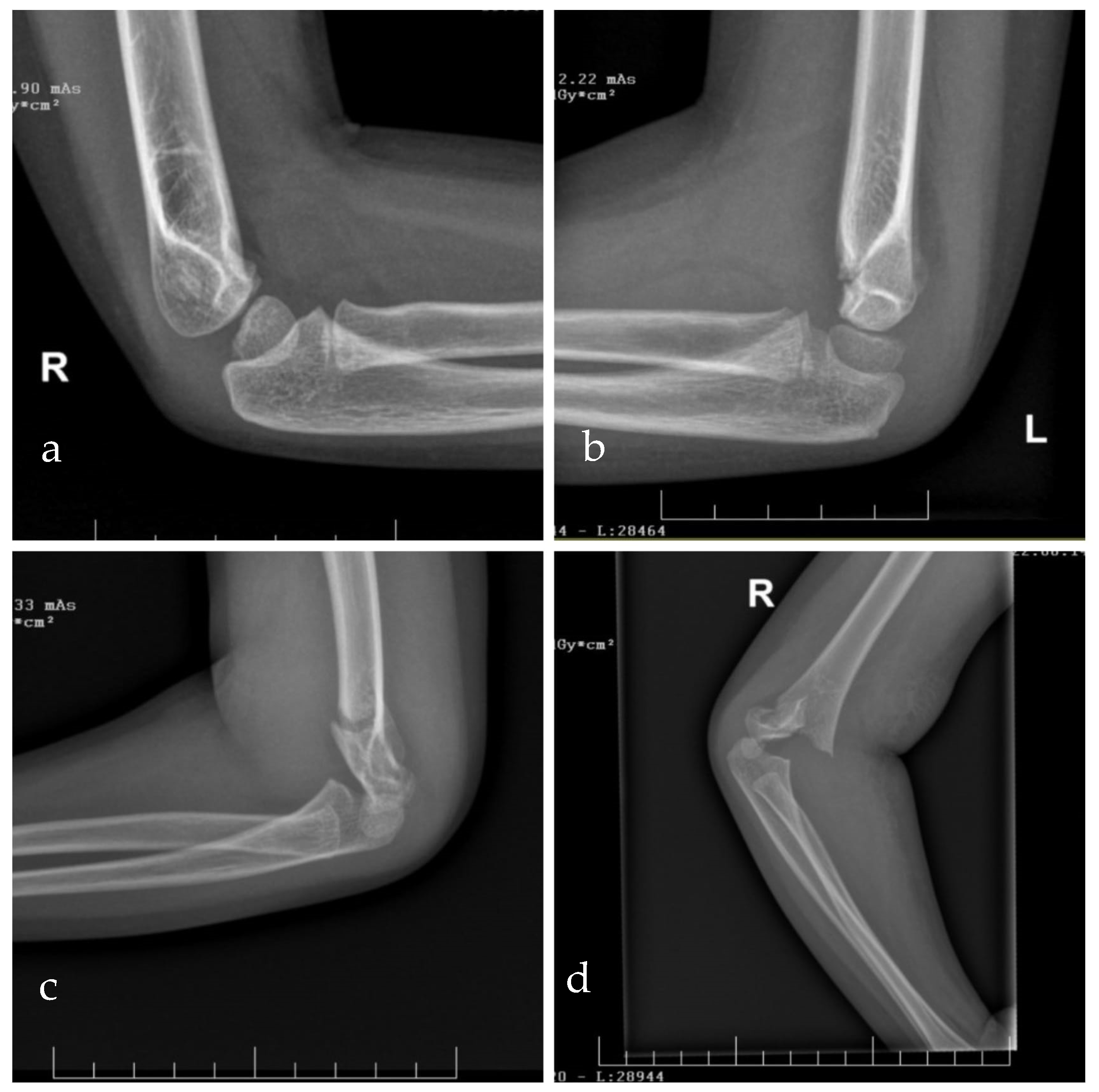 Modern Treatment of Supracondylar Humeral Fractures in Children
