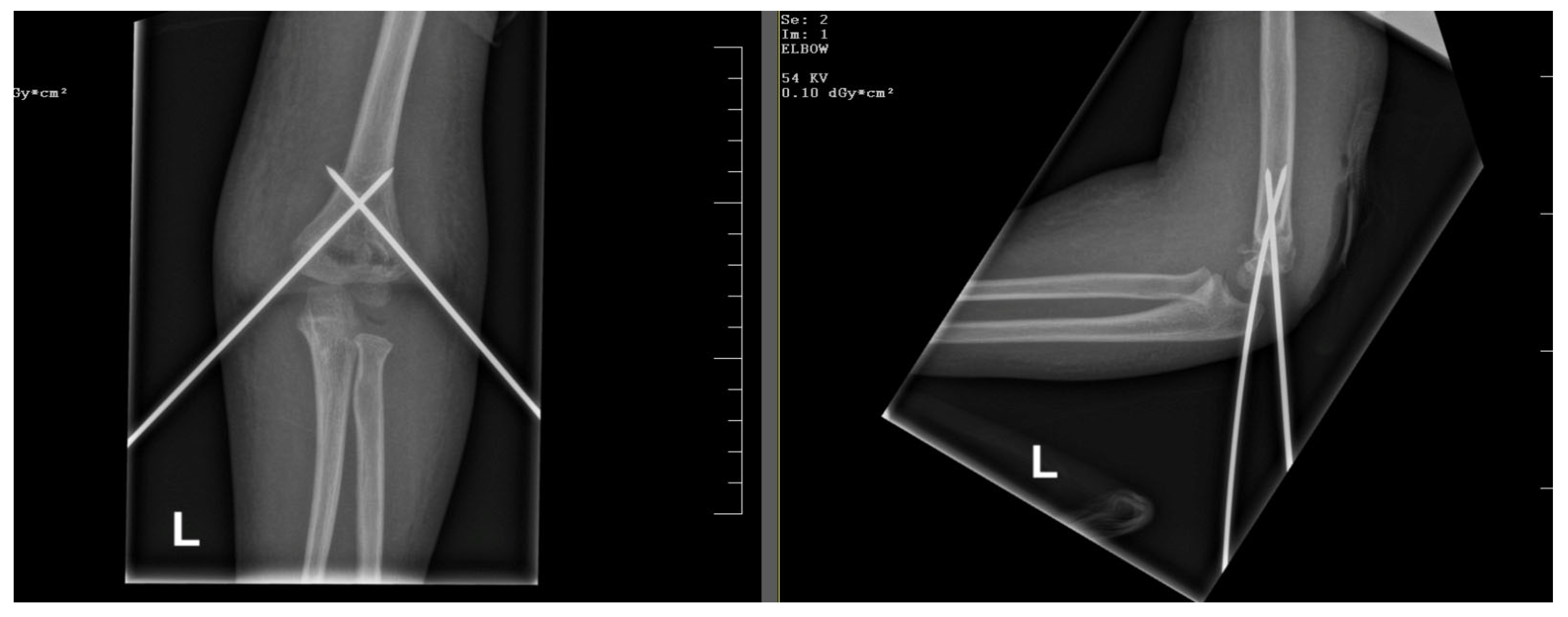 Modern Treatment of Supracondylar Humeral Fractures in Children