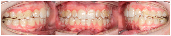 Orthodontic Management of Class II Malocclusion with Clear Aligners ...