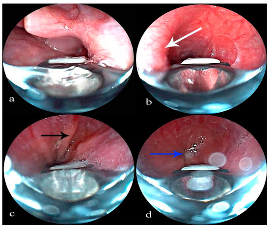 Use of Endoscopic Ultrasound with Bronchoscope-Guided Fine-Needle ...