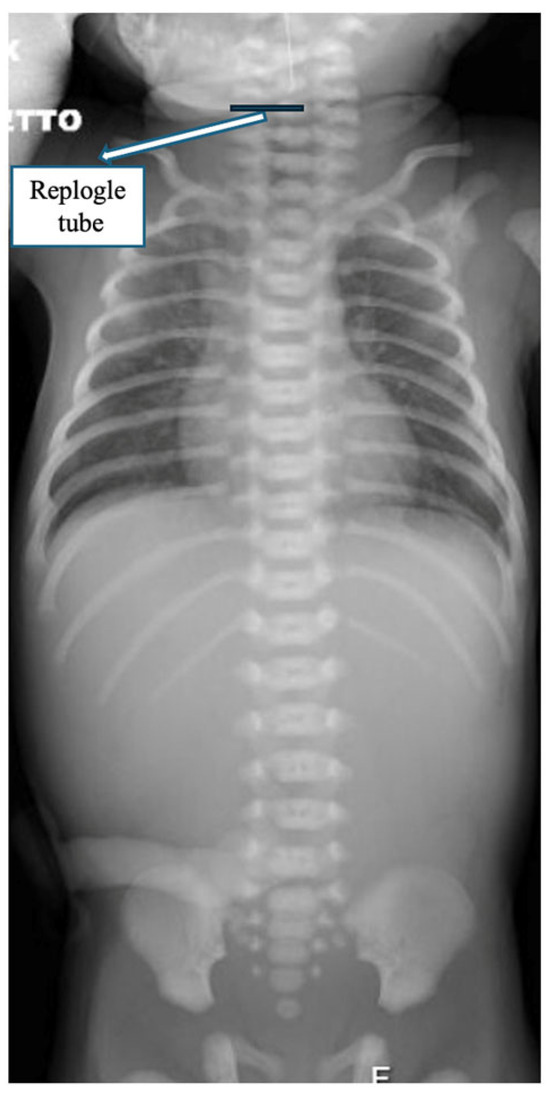 Mind the Missing Gap: A Cervical Variant of Type A Esophageal Atresia
