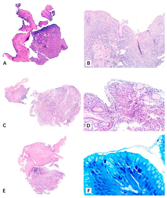 Pediatric Heterotopic Gastric Mucosa of the Cervical Esophagus (Inlet ...