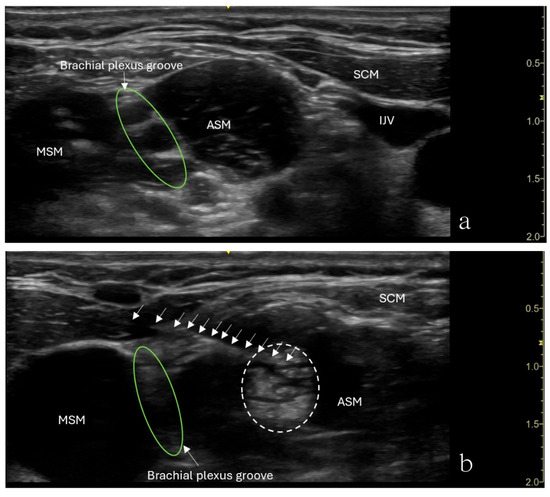 Anterior Scalene Muscle Block for Diagnostic and Surgical Planning in ...