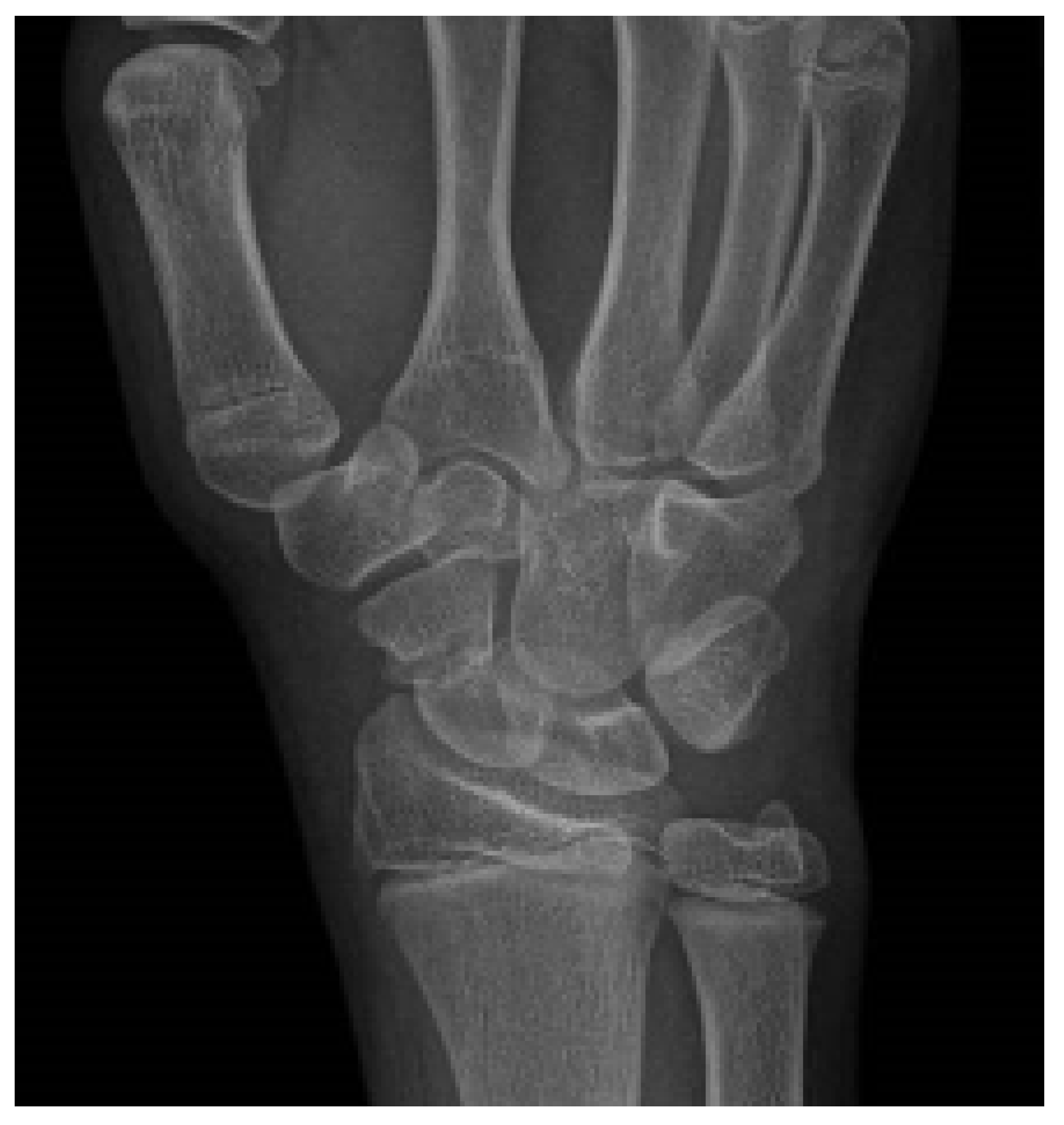 Surgical Treatment of Scaphoid Non-Union in Adolescents: A Modified ...