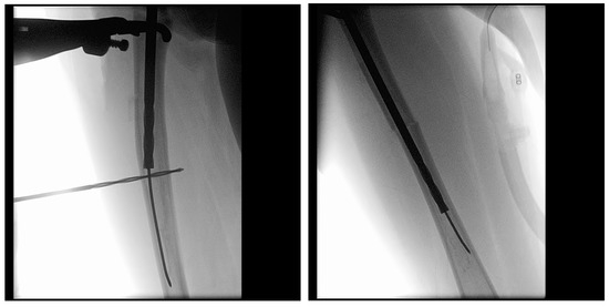 Tips and Tricks for Installation of the SLIM Nail in Osteogenesis ...