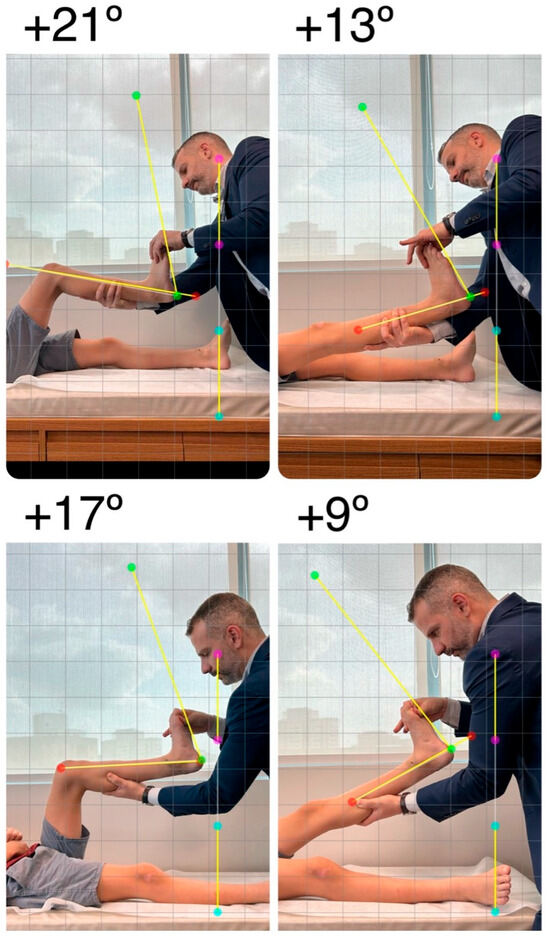 The Autistic Toe Walking: A Narrative Review for Interventions and ...