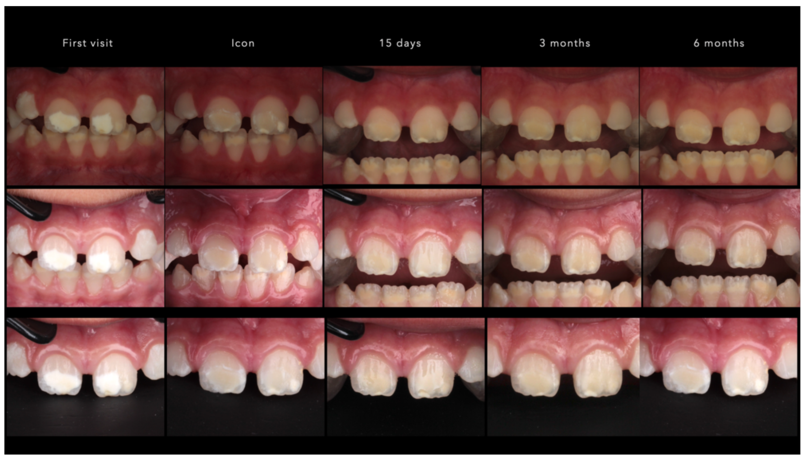 Resin Infiltration for Anterior Teeth Affected by Molar Incisor ...