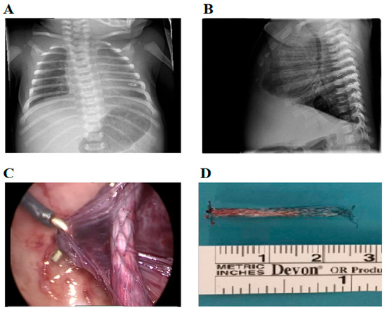 Challenges of Retained Thoracoamniotic Shunts in the Neonatal Period: A ...
