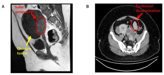 Identifying the Carcinogenic Mechanism of Malignant Struma Ovarii Using ...