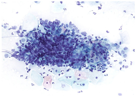 The Role of p16/Ki67 Dual Staining in Cervical Cancer Screening