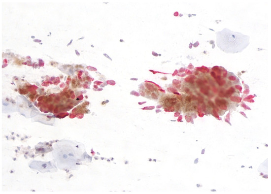 The Role of p16/Ki67 Dual Staining in Cervical Cancer Screening