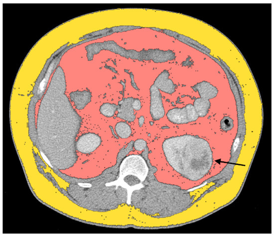 Radiogenomics and Texture Analysis to Detect von Hippel–Lindau (VHL ...
