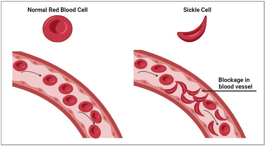 Sickle Cell Disease: Current Drug Treatments and Functional Foods with ...
