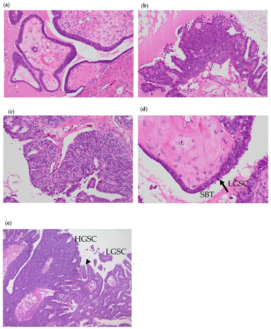 Molecular Analysis of High-Grade Serous Ovarian Carcinoma Exhibiting ...
