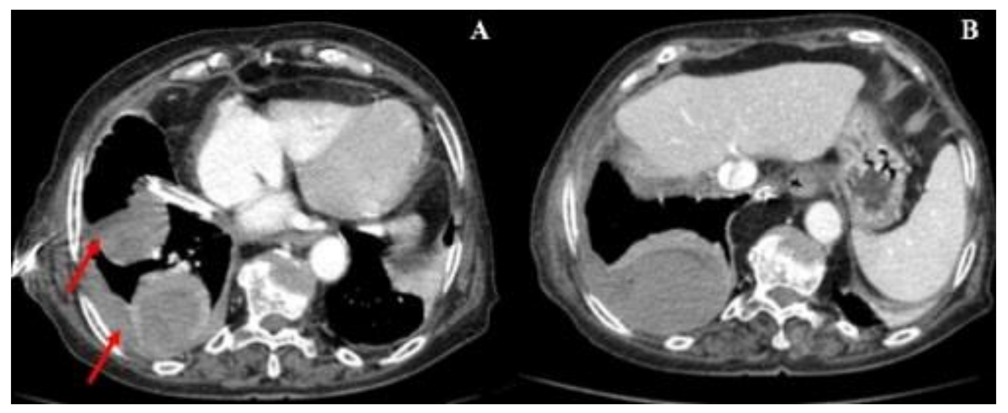 Not Always (and Only) Heart Failure—A Case Report of Primary Pleural ...