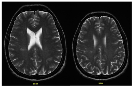 Mitral Valve Subacute Endocarditis Caused by Abiotrophia Defectiva: A ...