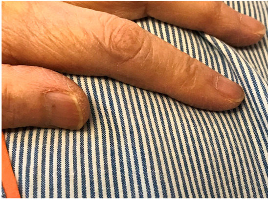 White Nail as a Static Physical Finding: Revitalization of Physical ...