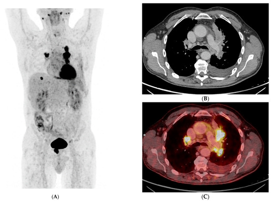 Uncommon Presentation of Granulomatosis with Polyangiitis Mimicking ...