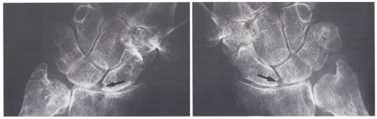 Adalimumab-Induced Rhupus Syndrome in a Female Patient Affected with ...