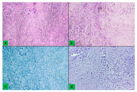 Five-Year Retrospective Study of Uterine STUMP and Leiomyosarcoma