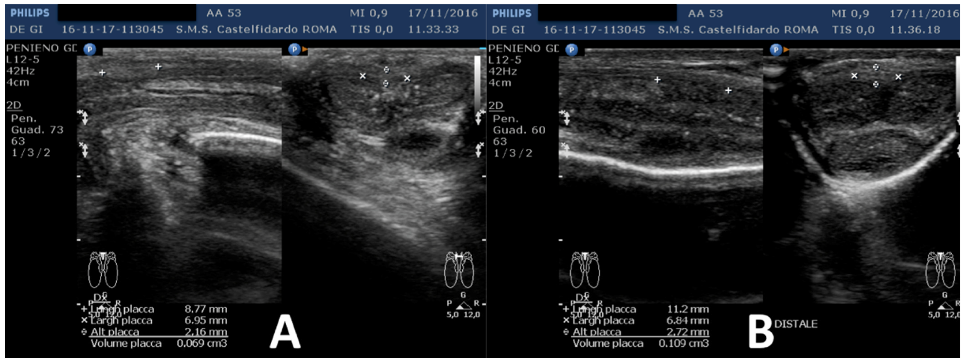 Peyronies Disease